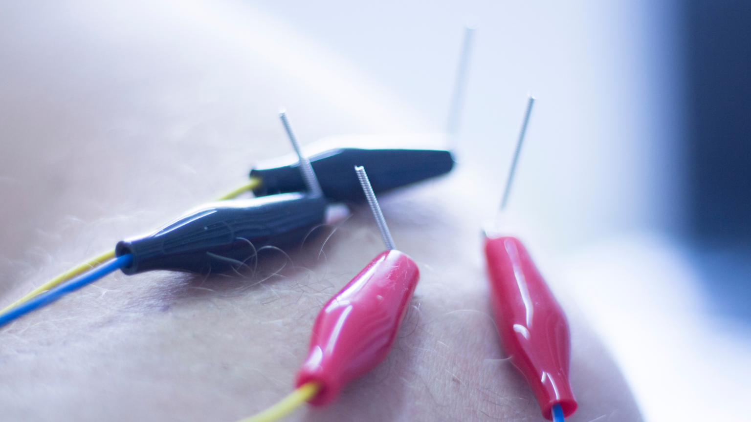 Dry Needling vs. Acupuncture: Relief at the Point of a Needle ...